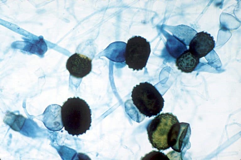 Mucormycosis - Infection, Treatment and Predisposing Factors